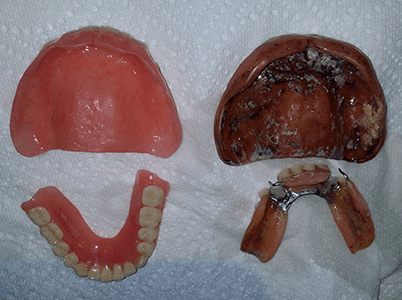 Dentures | Mobile Dentistry of Arizona